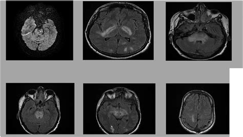 Mri T2 Weighted Sequence And Flair Showing Diffuse Hyper Intense Download Scientific Diagram
