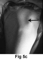 ORI Cinical Examination Of Unstable Shoulders