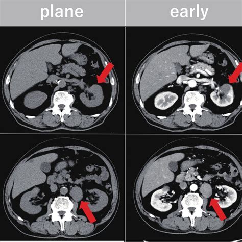 Moderate To Severe Global Hypokinesis Of The Lv On Echocardiogram Lv Download Scientific