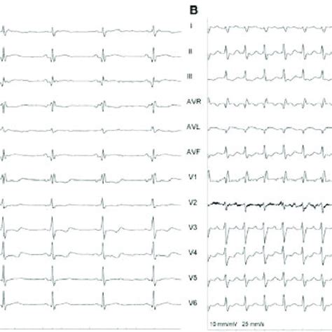 A Baseline Electrocardiogram Showing Sinus Showing Rhythm And Right Download Scientific