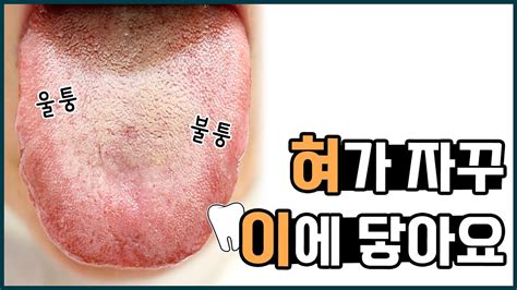 치흔 이빨자국 때문에 혀 모양이 울퉁불퉁하고 혀가 따끔거려요 Youtube