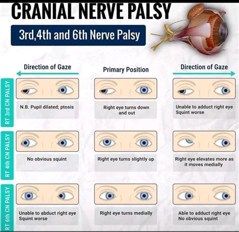 Cranial Nerve Palsy Third Fourth And Sixth Cranial Nerve Palsies