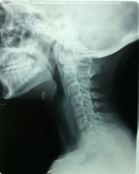 ¿cómo Leer Una Radiografía De Columna Cervical A Propósito De Un Caso