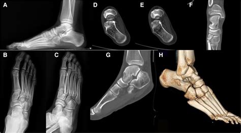 Navicular Fracture The Navicular Bone