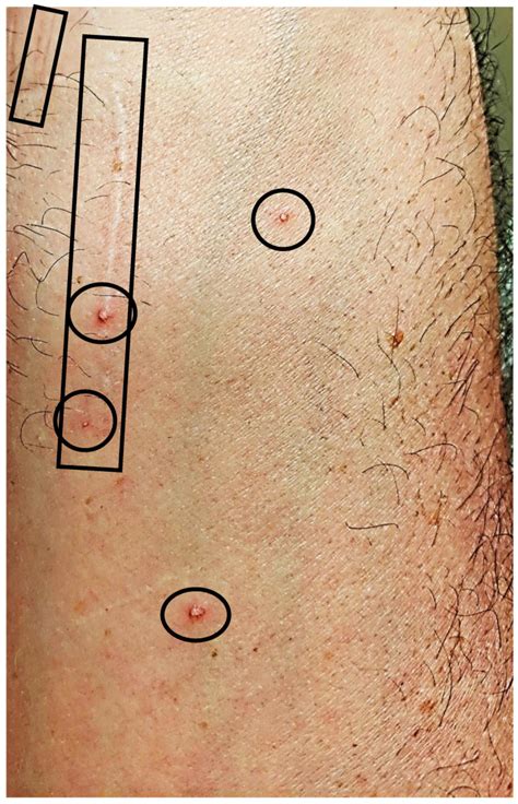 Bartonella Associated Cutaneous Lesions Bacl In People With