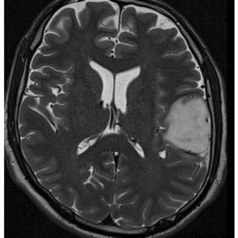 Lgg After Volumetric Segmentation In T2 Weighted Mri Download
