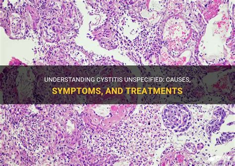 Understanding Cystitis Unspecified Causes Symptoms And Treatments Medshun