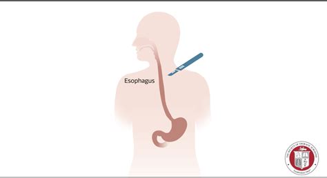 Esophagectomy For Cancer Risk Calculator Sts