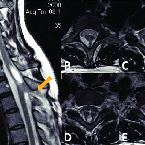 Illustration Of Disc Osteophyte Complex Size Measurement Download