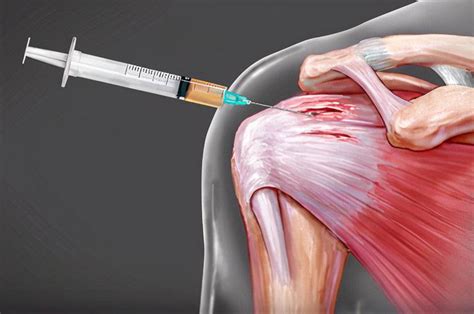 Subacromial Injection