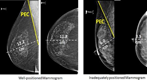 Mammogram Models Code And Papers CatalyzeX