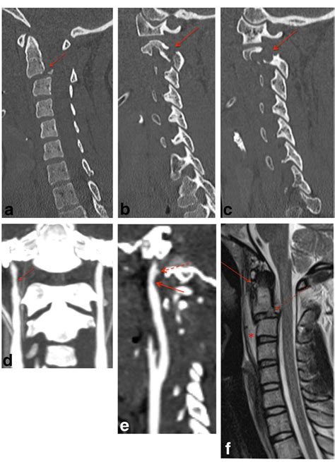 A—c Sagittal And Parasagittal Views Of An Effendi Type 2