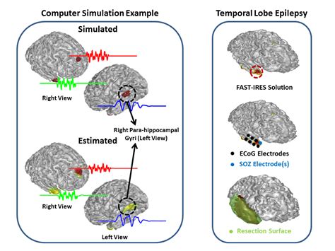 Imaging Ictal Activity From Scalp Eeg By Means Of A Fast Spatio