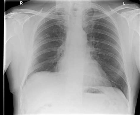 Lobectomy Is Indications For Surgery Technique Consequences Rehabilitation Medicine