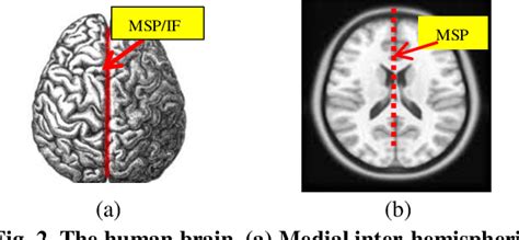 Figure 2 From Brain Tumor Detection Based On Asymmetry And K Means Clustering Mri Image