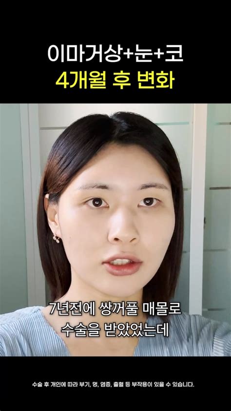 📍끝까지 보세요 눈성형 코성형 이마거상 후 드라미틱한 변화 눈성형 눈수술 쌍꺼풀 엔젤아이 이마거상 수술전후 수술후기 수술후 성형외과