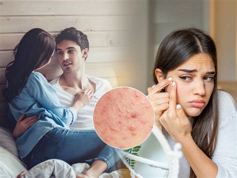 सेक्समुळे चेहऱ्यावर पिंपल्स येण्याचे प्रमाण वाढते का डॉक्टर सांगतात खरं काय आणि गैरसमज कोणते