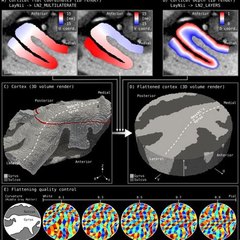 Brainlab Iplan Cranial Views Of Two Imaging Workups Of The Same Patient Download Scientific