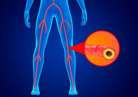 Peripheral Artery Disease Pad Causes Symptoms And Treatments