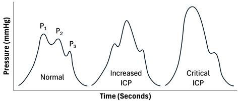 Intracranial Pressure Icp Trauma Icu