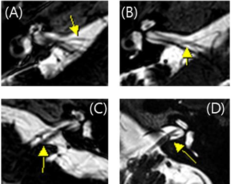 Gorrie Classification Of Aica Loop A Aica Loop Arrow Running
