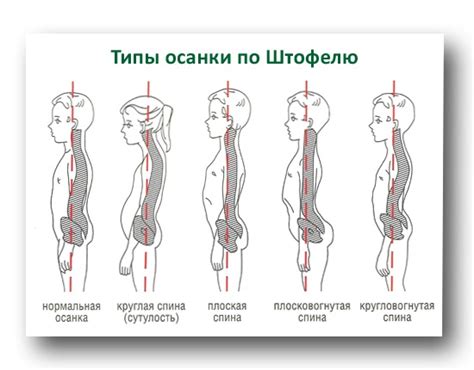 Нарушение осанки Altmed
