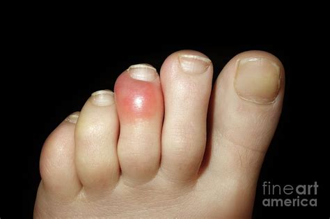 Chilblain Photograph By Cordelia Molloy Science Photo Library Pixels