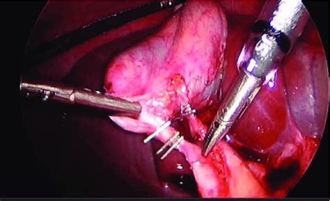 Critical View Of Safety Technique In Laparoscopic Cholecystectomy Download Scientific Diagram