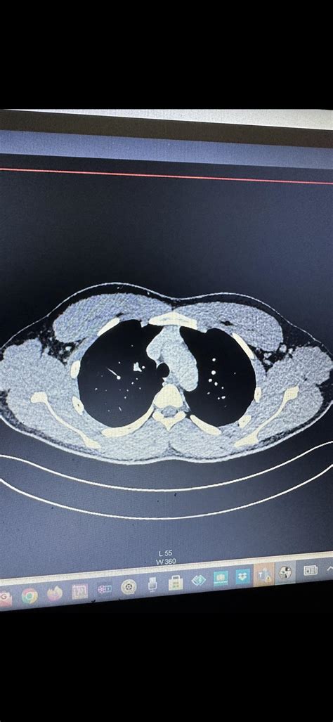Ct Thymic Tissue Rmedical