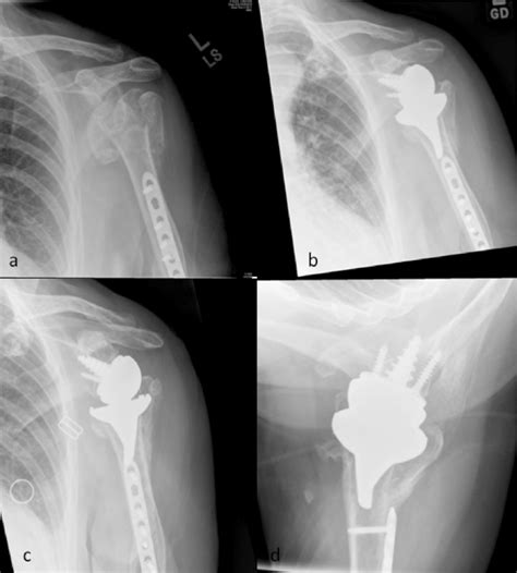 Proximal Humerus Neck Fracture