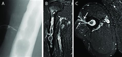 Chronic Osteomyelitis Of The Right Humerus With Fistula Formation Download Scientific Diagram
