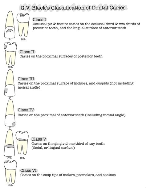 Gv Black Classification Of Caries In 2025 Dental Assistant Study