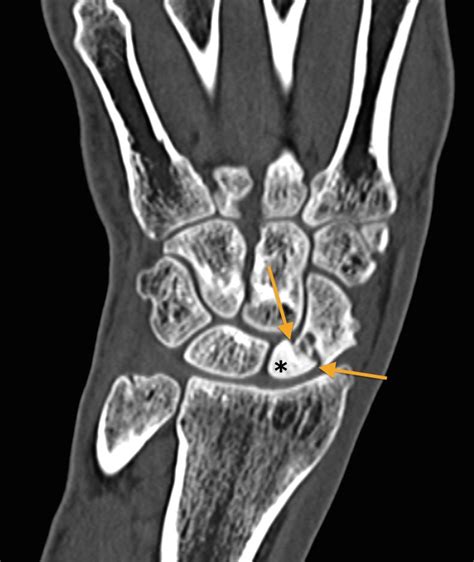 Scaphoid Avn Ct Radiology At St Vincents University Hospital