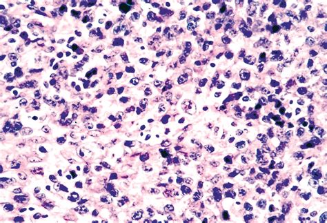 Pathology Outlines Dedifferentiated Chondrosarcoma