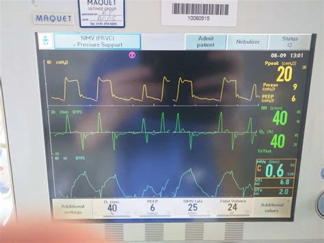 Servo I Ventilator Flow Trigger At Edward Johns Blog