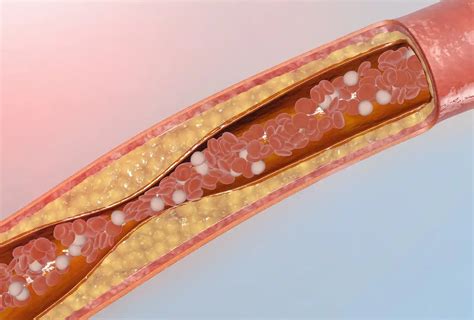 Polycaprolactone Spearheading Innovation In Drug Delivery Systems