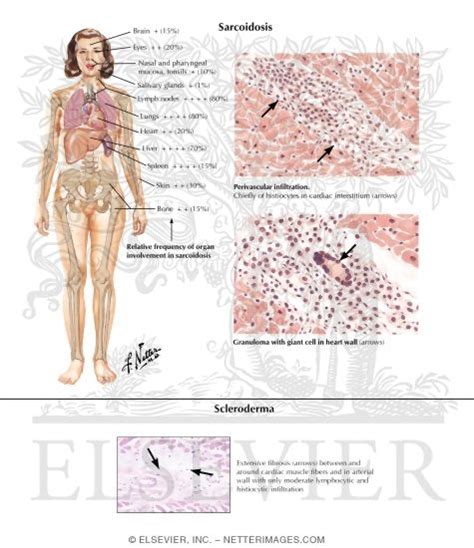 Myocarditis In Sarcoidosis And Scleroderma