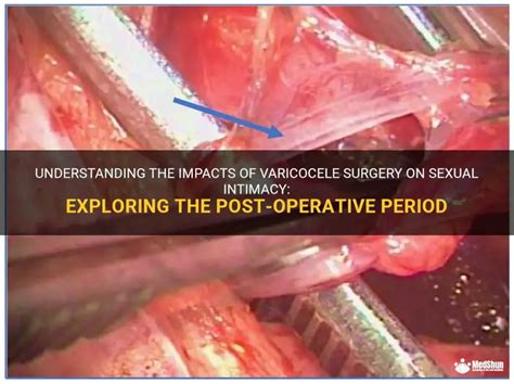 Understanding The Impacts Of Varicocele Surgery On Sexual Intimacy