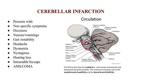 Posterior Circulation Ischemic Embolic Stroke Pdf