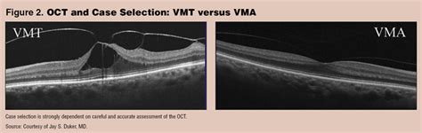 Vitreomacular Adhesion Addressing Patient Selection And Safety
