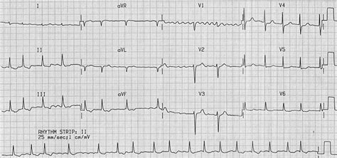 Digoxin Salvador Dali Mustache Ecg