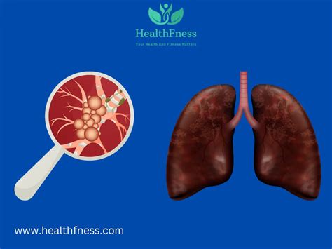 Small Cell Lung Cancer Paraneoplastic Unveiled Bridging Science And
