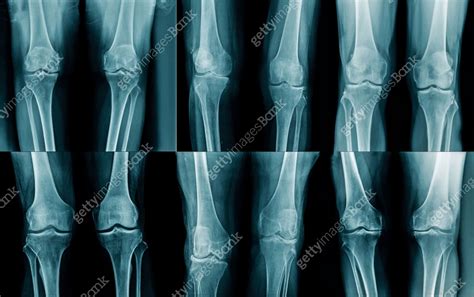 Collection X Ray Oa Knee 이미지 1013719374 게티이미지뱅크