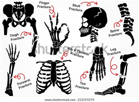 Set Bone Fracture Icon Pelvic Hip Stock Vector Royalty Free 252593374 Shutterstock