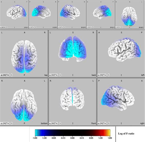 Eloreta Source Current Density In Alpha 812 Hz In Me Patients Compared Download Scientific