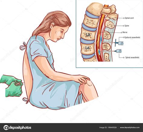 Epidural Nerve Block Injection Stock Vector Image By ©corbacserdar