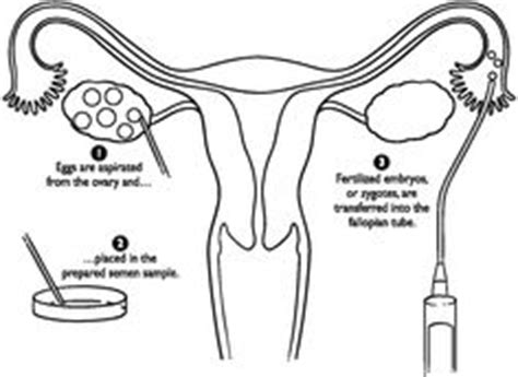 Diagram Of A Partial Or Simple Vulvectomy On One Side Of The Vulva Female Reproductive System