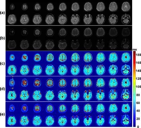 Figure 4 From Robust Single Shot T2 Mapping Via Multiple Overlapping