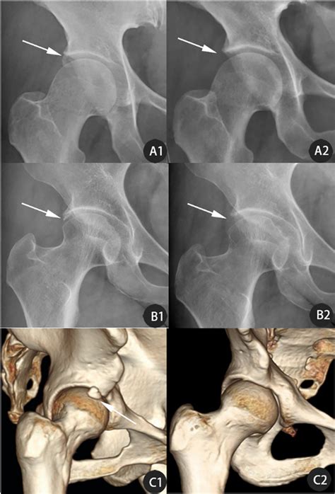 Preoperative X Rays A1 B1 And 3d Reconstruction C1 Of Labrum Download Scientific Diagram