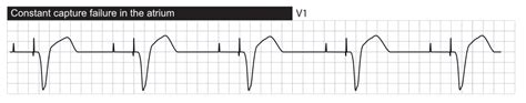 Assessment Of Pacemaker Malfunction Ekg And Echo